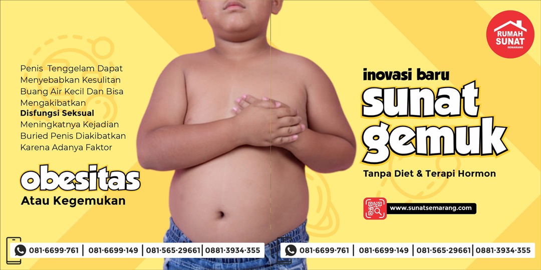Metode Sunat Gemuk untuk Anak dan Penanganannya Terbaik - 081.6699.761